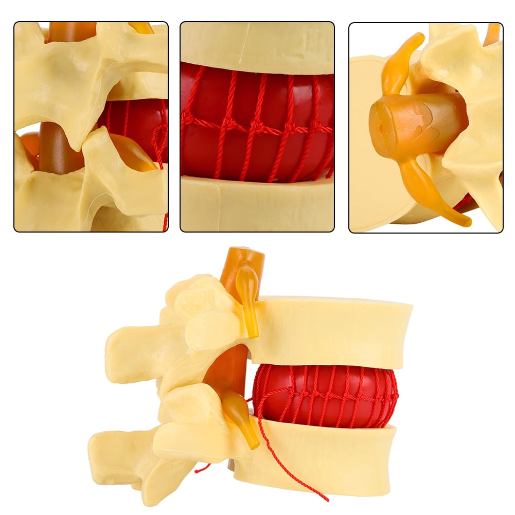 Modelo de demostración de hernia del disco lumbar de la columna ...