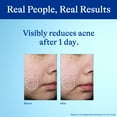 Differin Acne Spot Treatment with 10 Benzoyl Peroxide for Face and Body ...