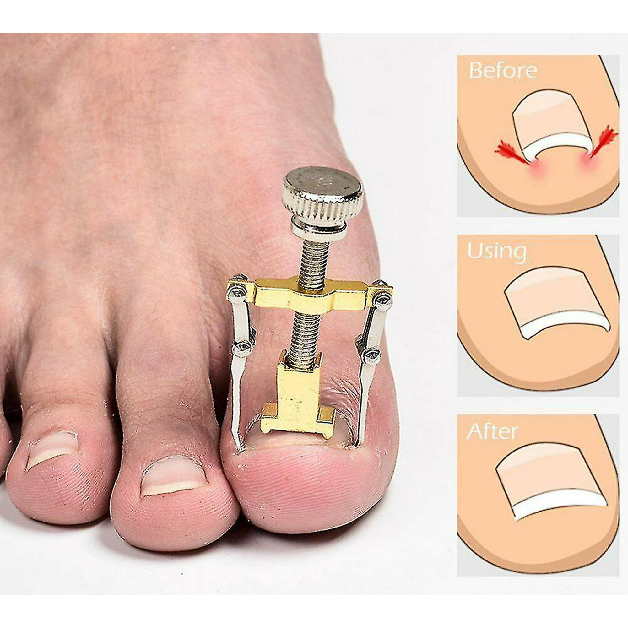 Click here for Waca09 Ingrown Toenail Manicure Pedicure Foot Care... prices