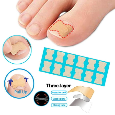 Ingrown Toenail Corrector Stickers Foot Care Stickers Non Glue Toenail ...