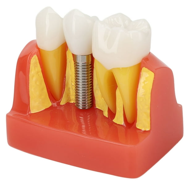 Análisis de implantes Puente de corona, Modelo de implante dental ...