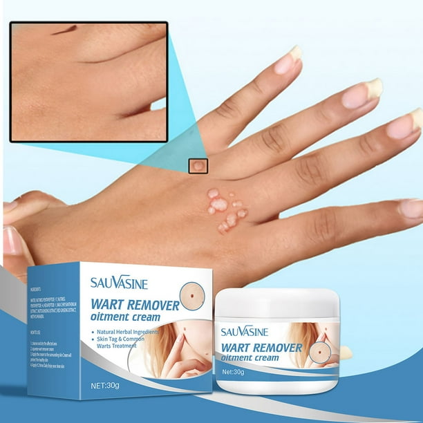 Eliminador de verrugas, crema para aliviar el dolor, verruga, topo, etiqueta de la piel ...
