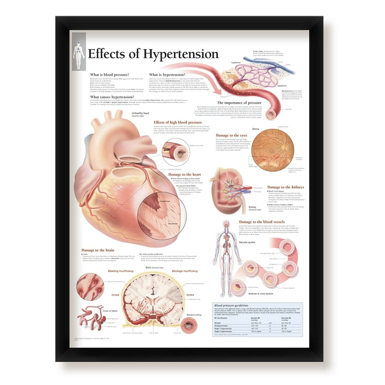 Understanding Hypertension Poster High Blood Pressure Causes Of High