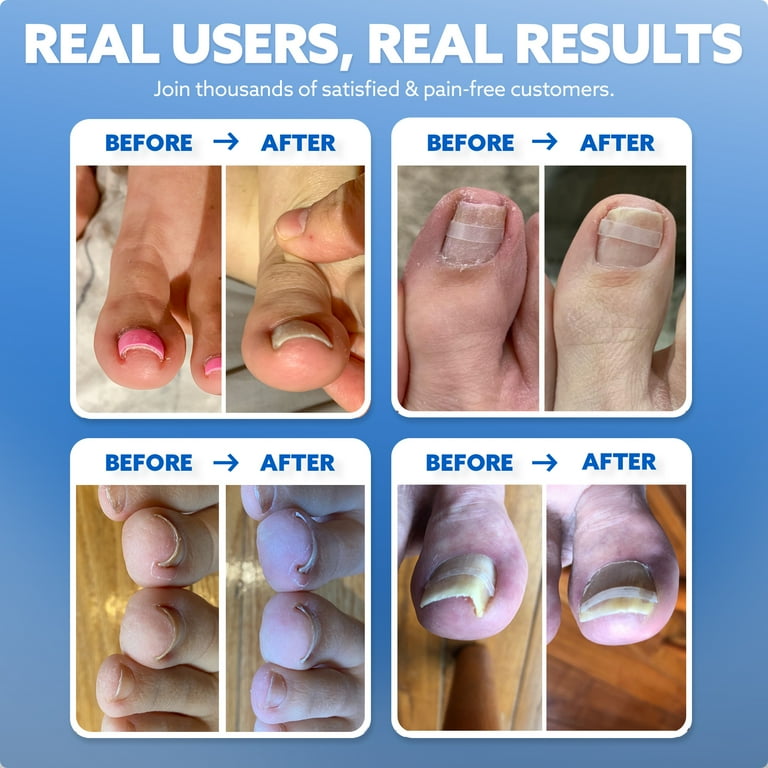 Ingrown Toenail Home Treatment Ingrown Toenail | NHS Inform