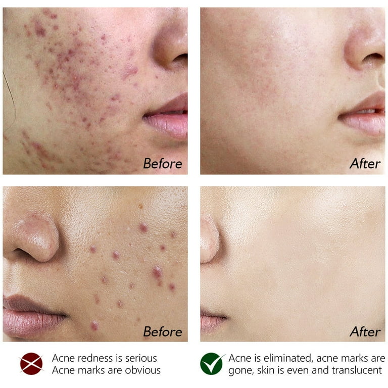 Severe Acne Rosacea