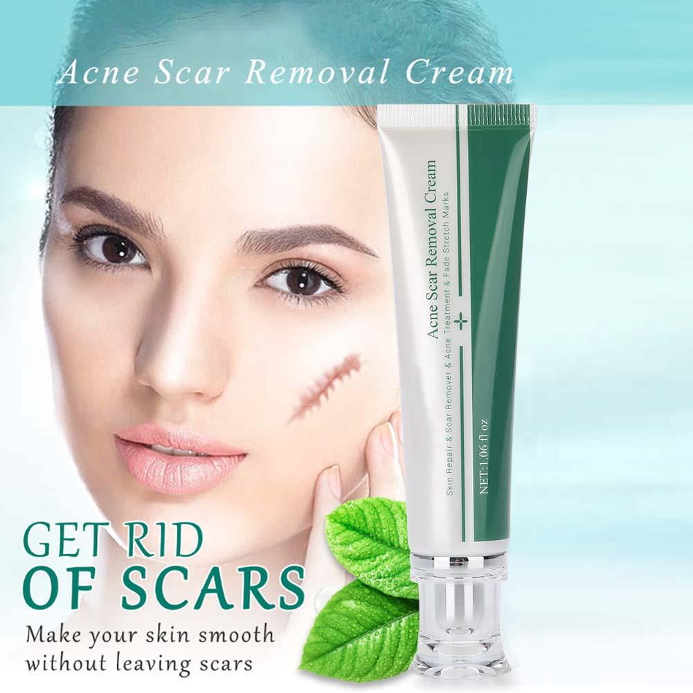 Acne Scars Removal Cream