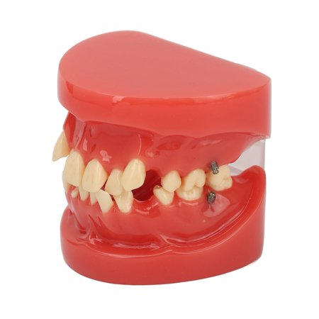 Teeth Study Model, Teeth Typodonts Model 24 Teeth Crowded Teeth Display ...