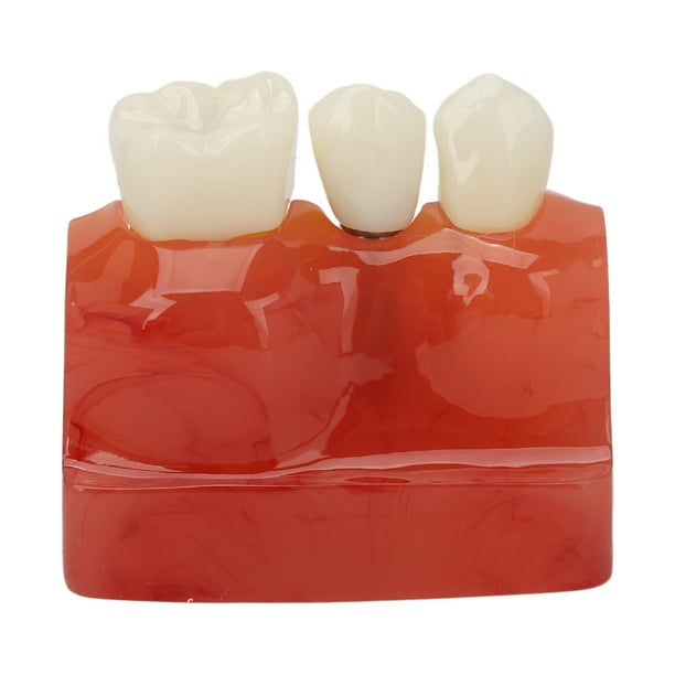 Implant Teeth Model,4 Times Dental Implant Dental Implant Demonstration ...