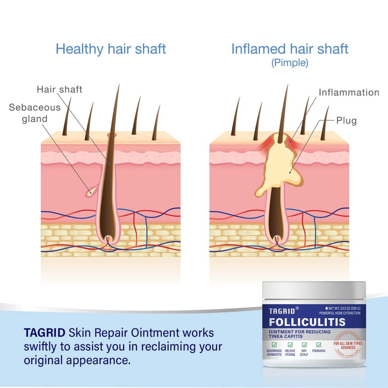Folliculitis Treatment