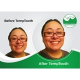 Temptooth #1 Seller Temporary Tooth Replacement Kit, Missing Tooth Kit ...