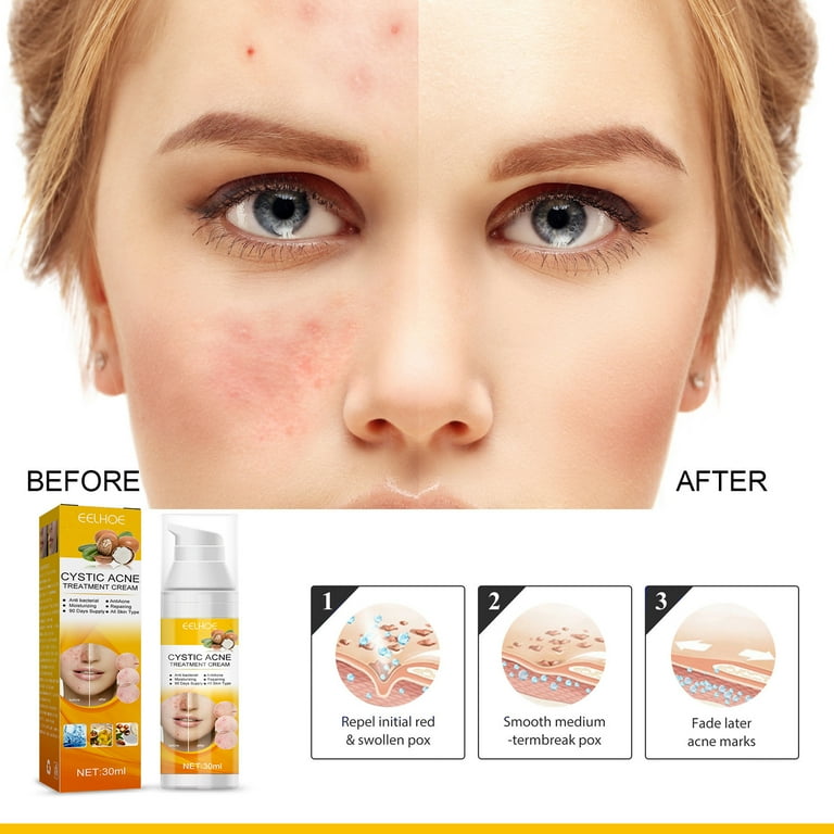 Eelhoe Cystic Hormonal And Severe Acne Treatment Cream For 60 Off