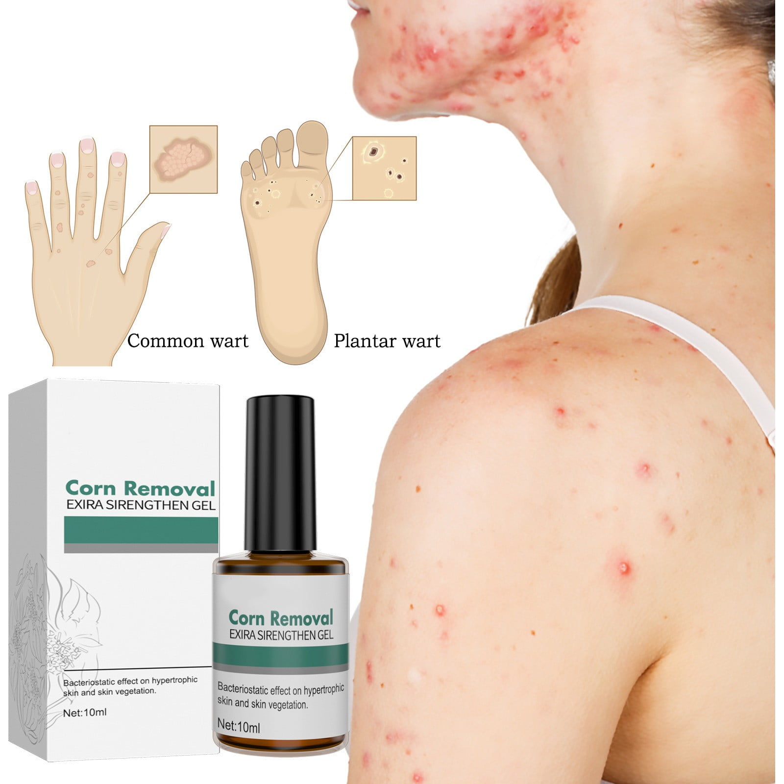 SDHJ23 Effective Liquid For Various Types Of Skin Lesions: Corns Warts ...