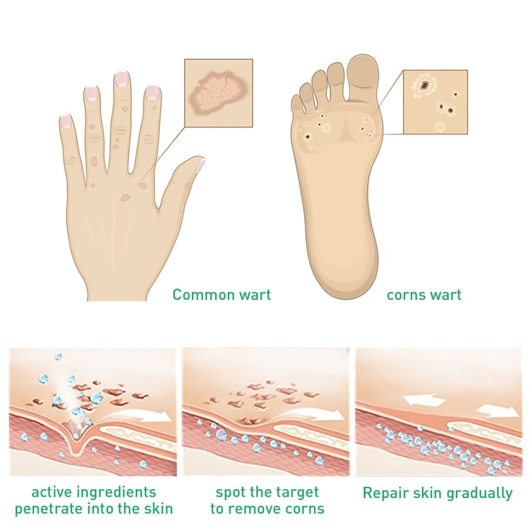 Common Warts Diagram