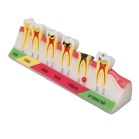Dental Caries Teeth Model,Dental Caries Model 6 Teeth Periodontal ...