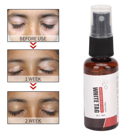 Vitiligo Care Spray, Easy Using Skin Friendly Skin Vitiligo Spray For ...