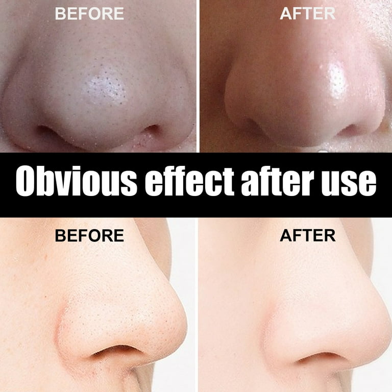 Nose Blackheads Before And After
