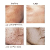 Miracle Care Pimple Eraser Acne & Anti-Aging Glycolic Treatment ...
