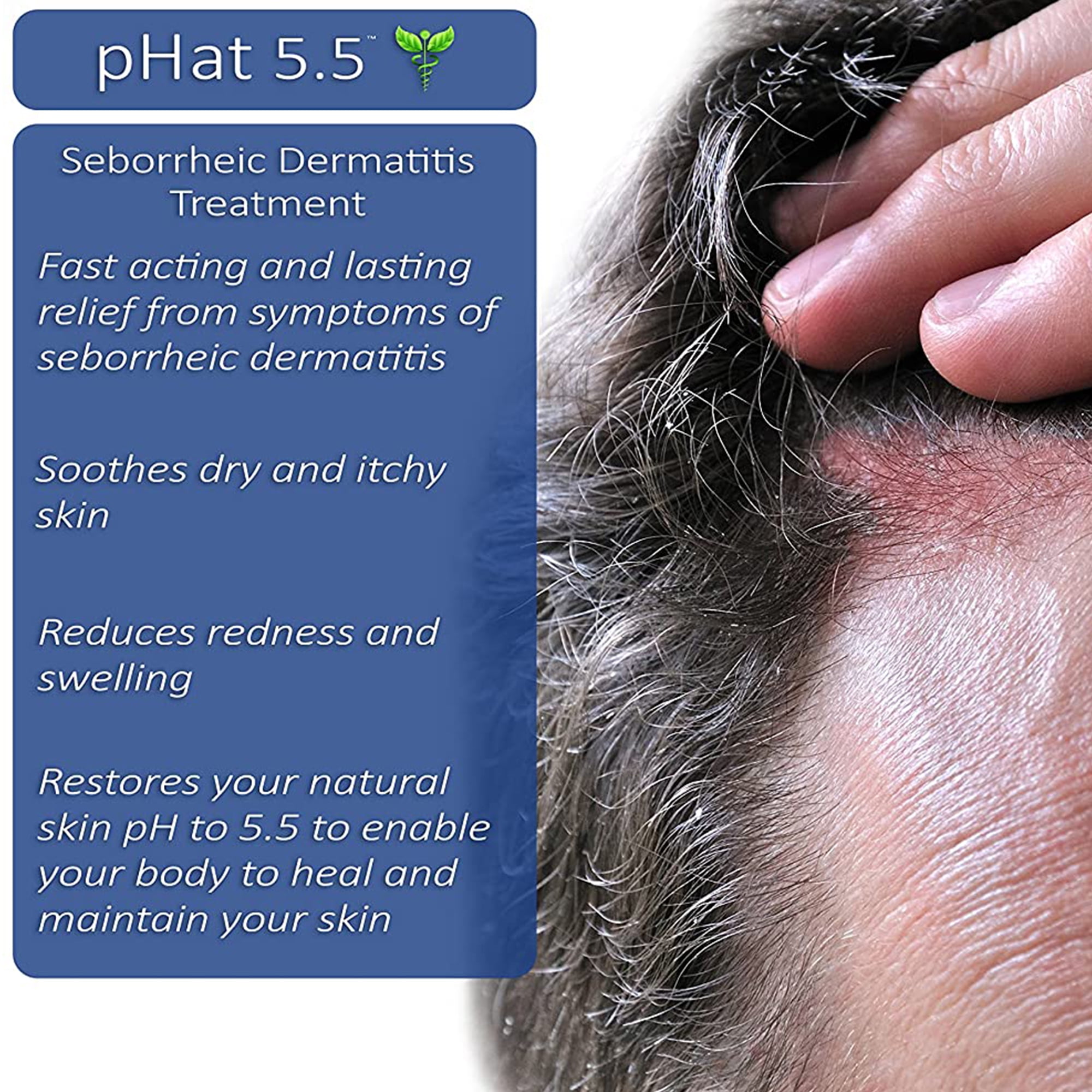 Seborrheic Dermatitis Scalp Hair Loss