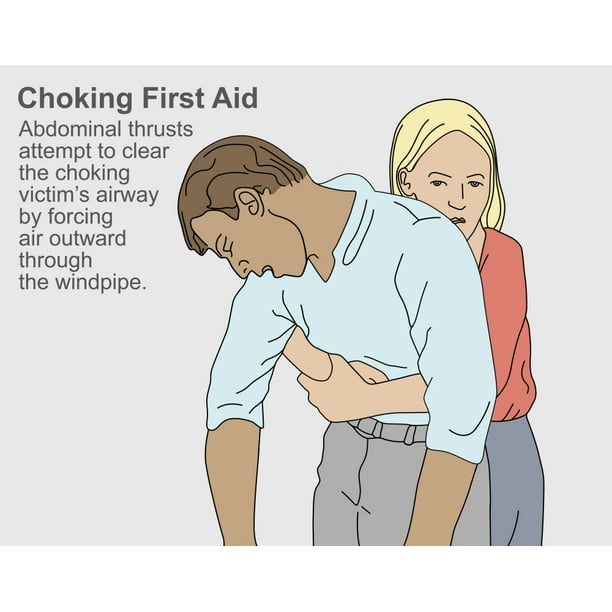 Heimlich Maneuver Poster Print By Gwen Shockeyscience Source