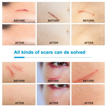 Silicone scar sheets,Fade Scar Mild Fade Scar Reduction Therapy Scar ...
