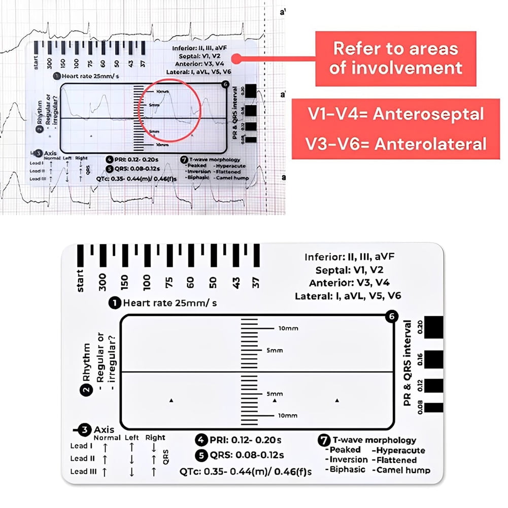 Heart Rate Scale ECG 7 Step Ruler EKG Orthopedic Scale Joint Scale ...