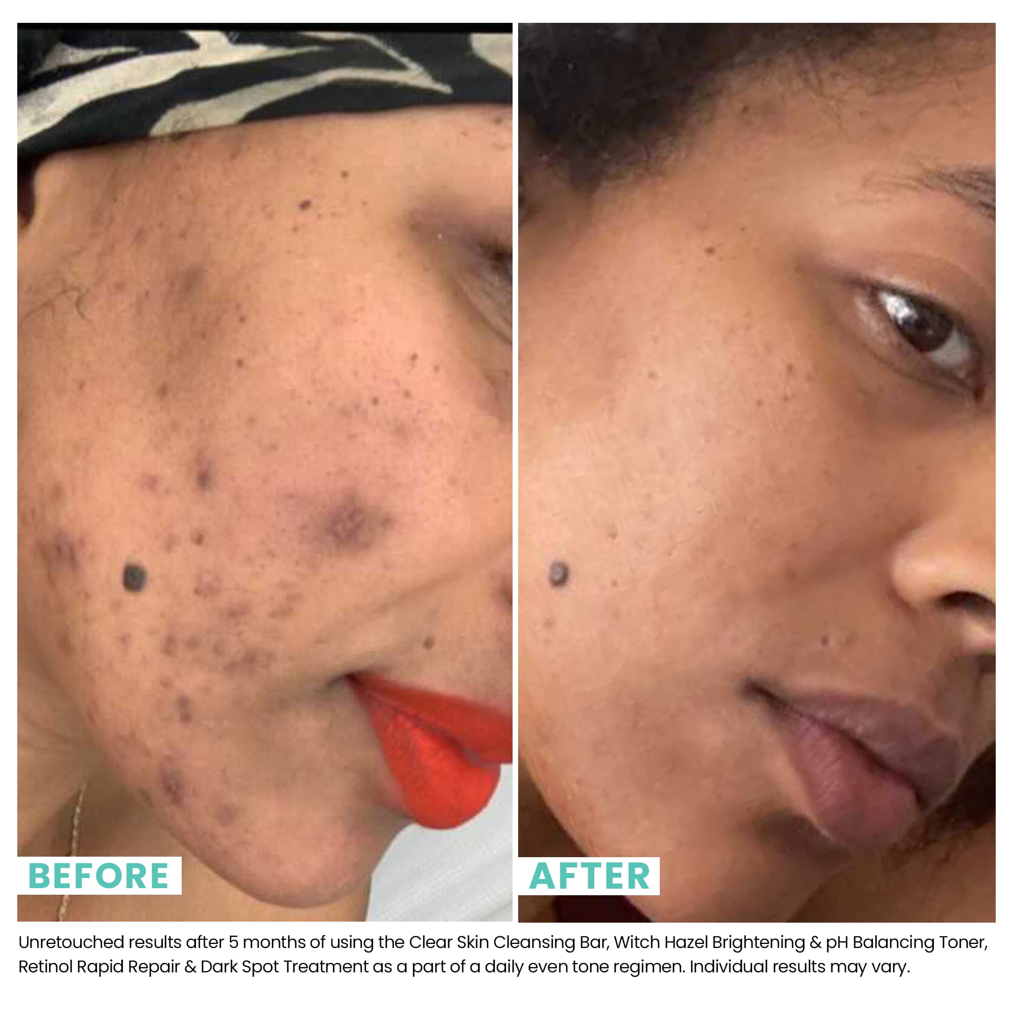 Dark Acne Spot Treatment
