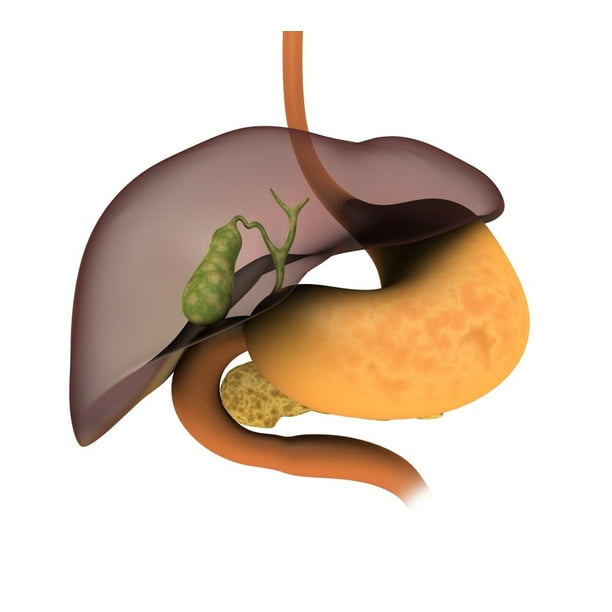 Gallbladder Real Image : color of urine and stool gallstones - The ...