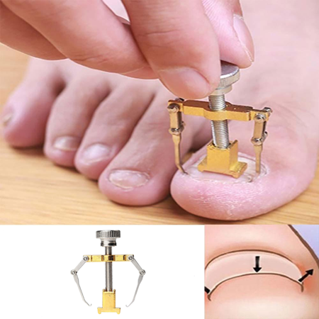 NUNADERNU Ingrown Toenail Toe Fixer Recover Correction Pedicure Foot ...