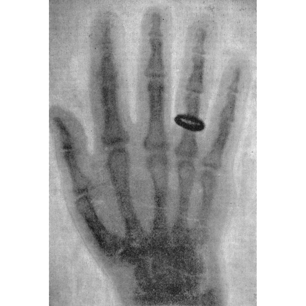 Roentgen X-Ray 1896 Nthe First Published X-Ray Photograph As Reproduced ...