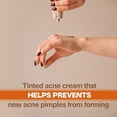 Adult Acnomel Acne Cream, 1.3 Oz HSA/FSA Eligible - Walmart.com