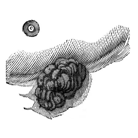 St. Martin'S Fistula. /Nillustration By William Beaumont Showing The ...
