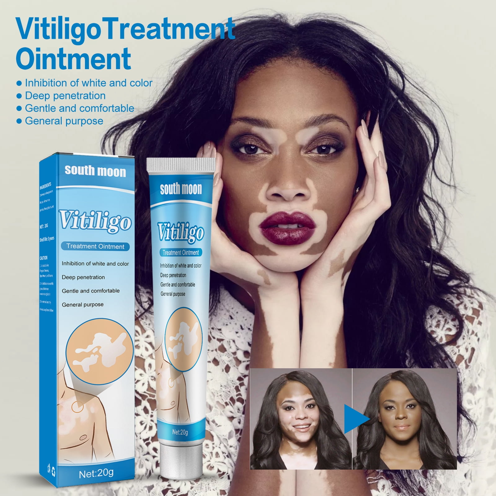 Crema para el cuidado del vitiligo, crema reguladora de la pigmentación ...