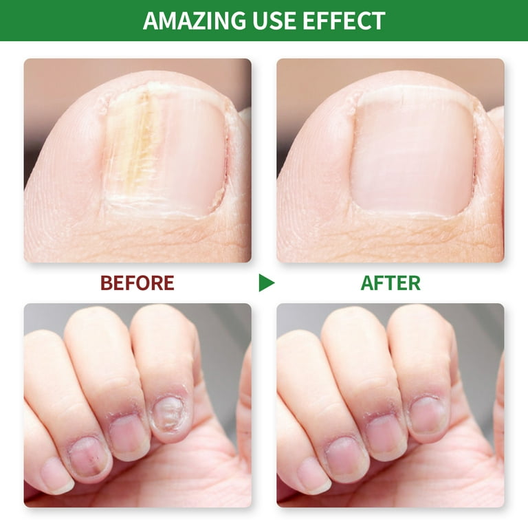 Ingrown Toenails Repair Serum Drop Nail Correction Recover