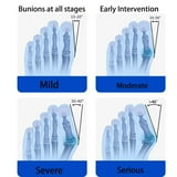 Bunion Corrector for Women Bunion Fix Device with Big Toe Straightener ...