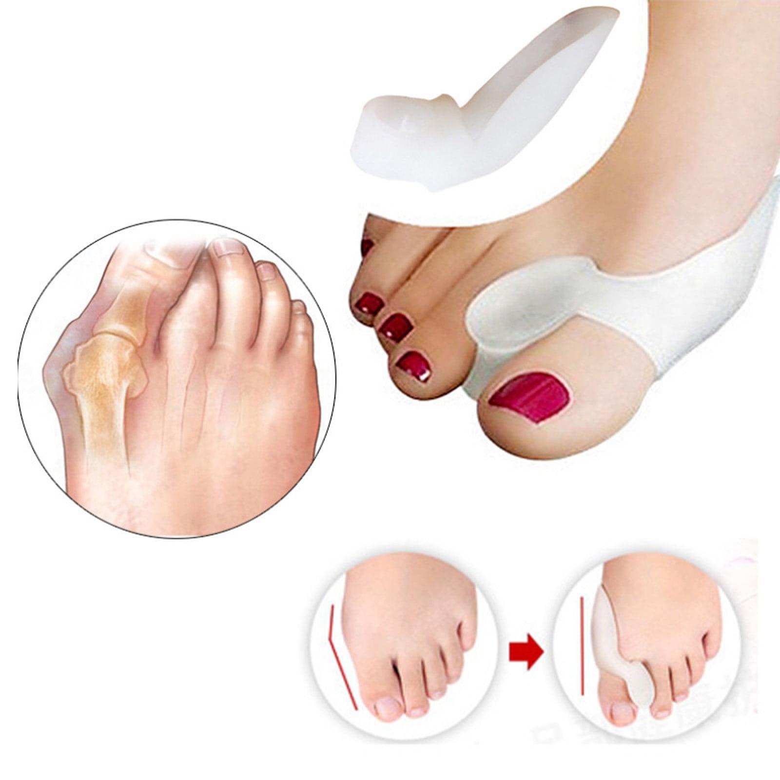 Qwang Hallux Valgus Orthosis Big Toe Orthosis Big Toe Valgus Orthosis Silicone Toe Splitter