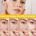 Vlemua Beauty Cystic Hormonal And Severe Acne Treating Cream Spray For