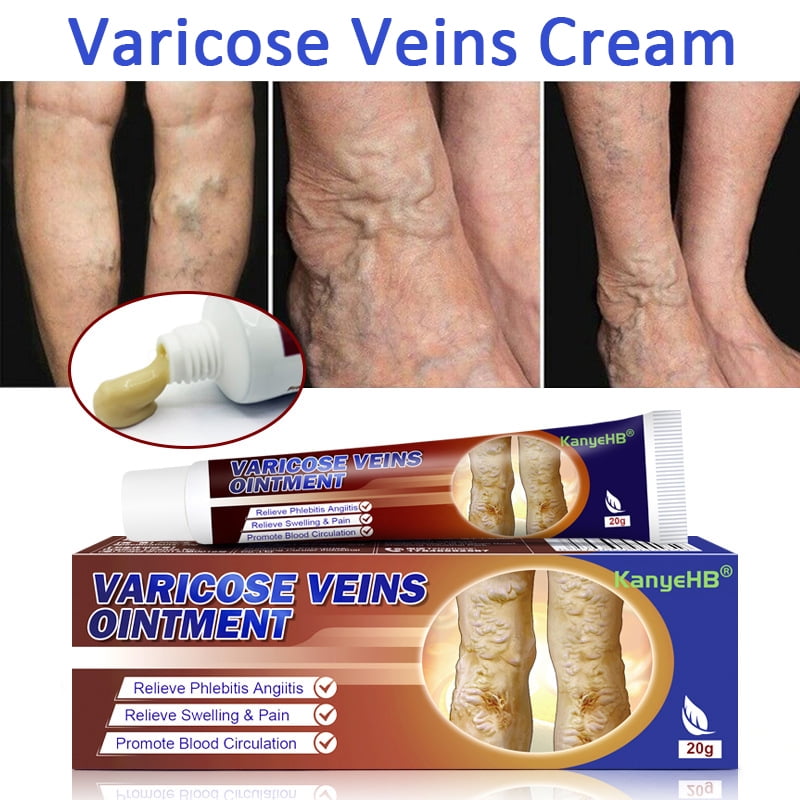 Buy 20G Varicose Veins Cream for Phlebitis Angiitis Inflammation ...