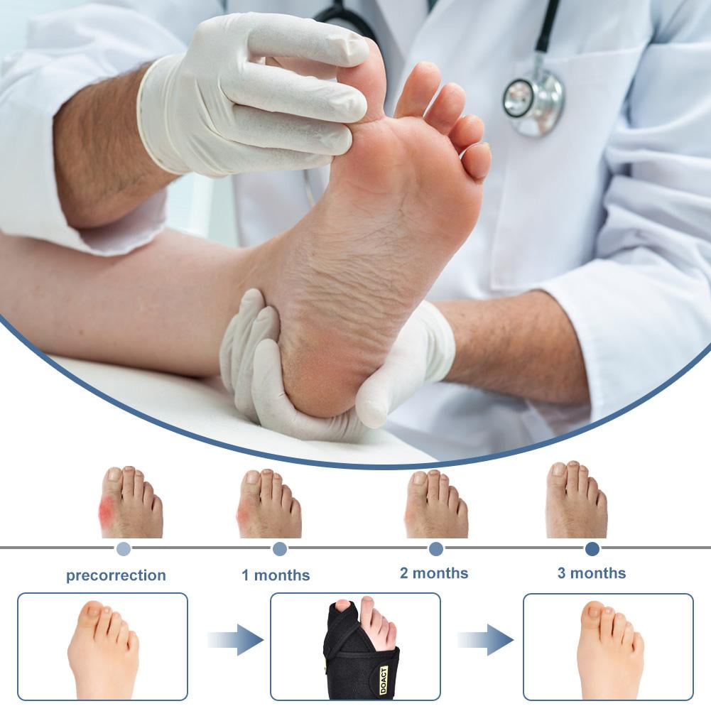 OTVIAP Bunion Corrector and Toe Straightener & Adjustable Orthopedic ...