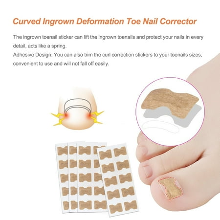 Toe Nail Corrector Deformation Ingrown Thumb Stickers Adhesive Toenail ...