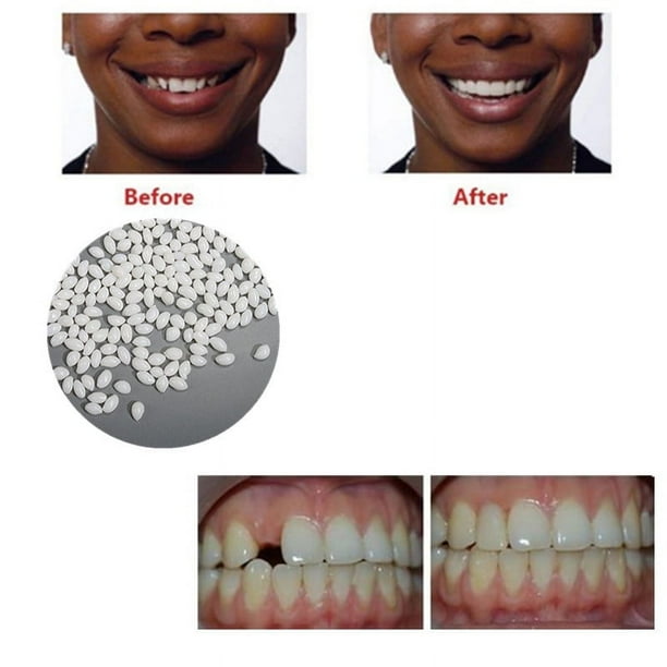 2 pieces of solid gum teeth, professional suture repair, single denture ...