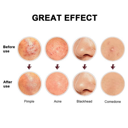 3 pcs Pimple Set Blackhead Remover Acne Clip Tweezer Comedone Extractor ...