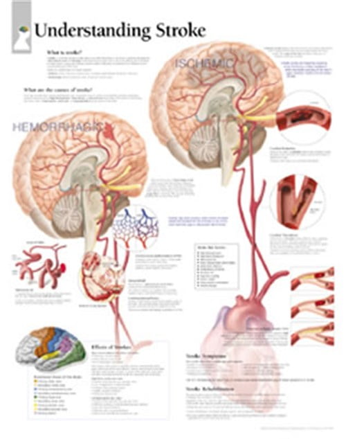 Pre-Owned Understanding Stroke chart : Wall Chart (Wallchart) - Walmart.com