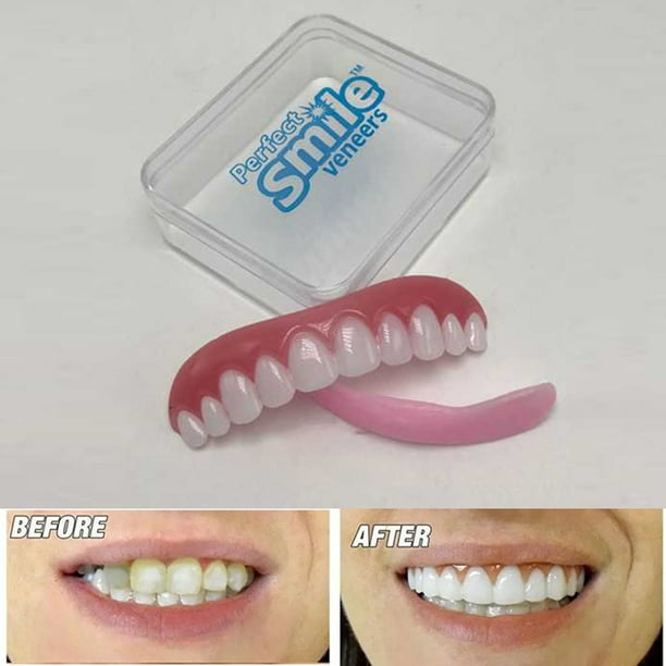 Snap Dental Veneers