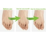 Onemayship Silicone Gel Toe Separator, Orthotics Bunion Spacer, Pain ...