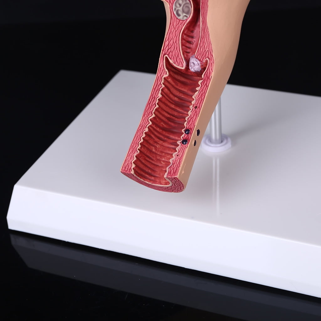 Buy CANKER Human Female Uterus Ovary Disease Dissection Pathology Model ...