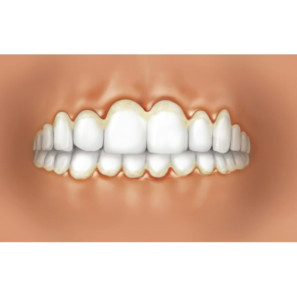 View of teeth showing gingivitis on gums. Poster Print by TriFocal ...