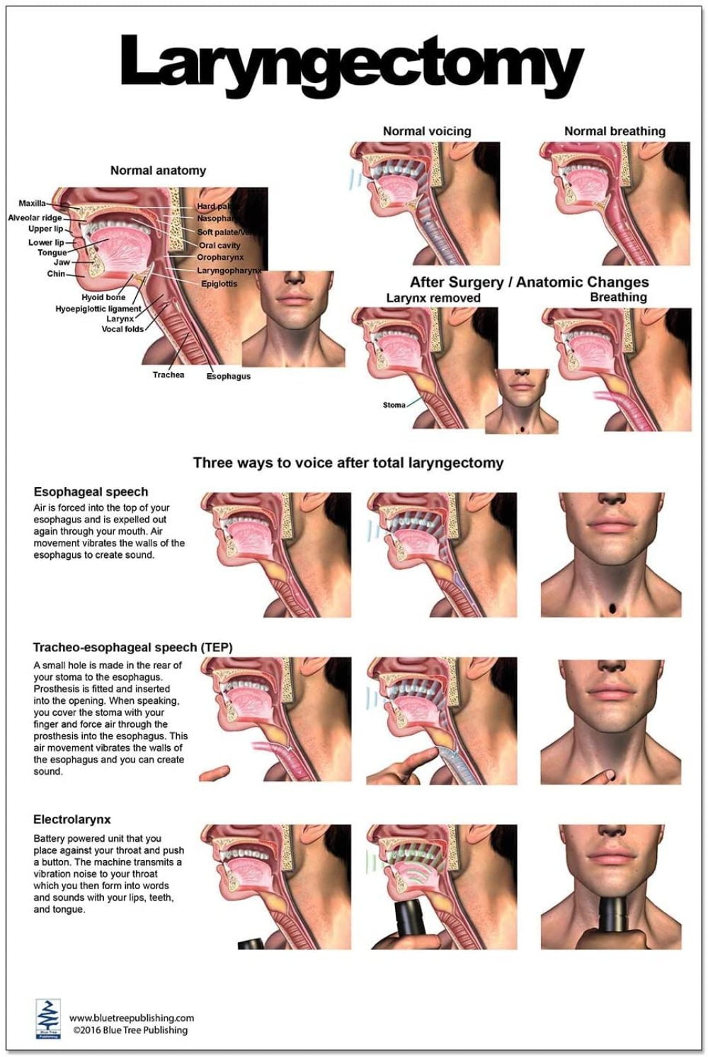 Laryngectomy Anatomy Poster 24x36inch Waterproof Three Ways To Voice