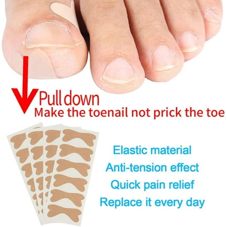 30Pcs Ingrown Toenails Stickers GlueFree Toenail Patch Painless ...