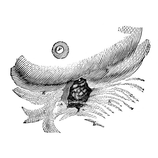 St. Martin'S Fistula. /Nillustration By William Beaumont Showing The ...
