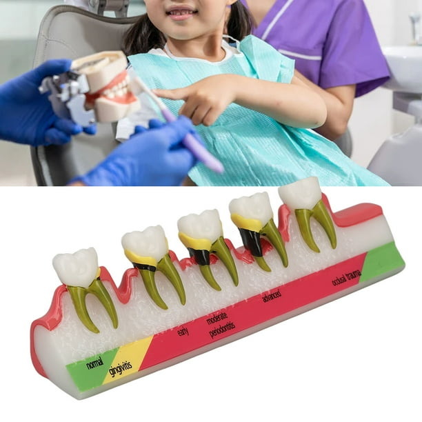 Periodontal Disease Model, Better Understand Periodontal Disease Teeth ...